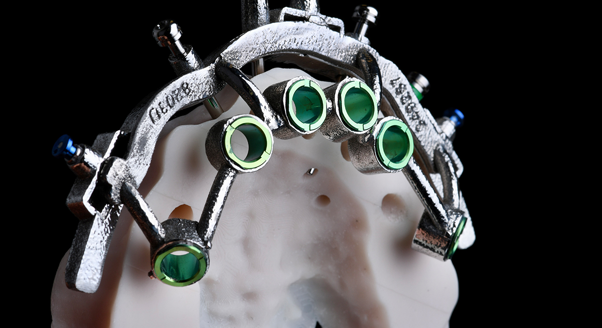 CHROME™ GUIDEDSMILE - Glodental LAB